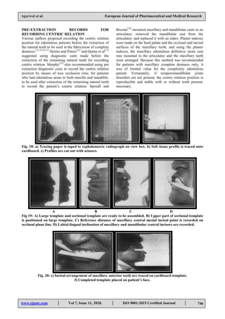 PRE-EXTRACTION RECORDS ARE RELIABLE TOOL FOR COMPLETE DENTURE ...