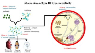 Hypersensitivity (Type 3 Hypersensitivity) | PPTX