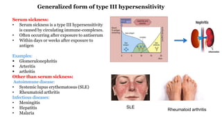 Hypersensitivity (Type 3 Hypersensitivity) | PPTX