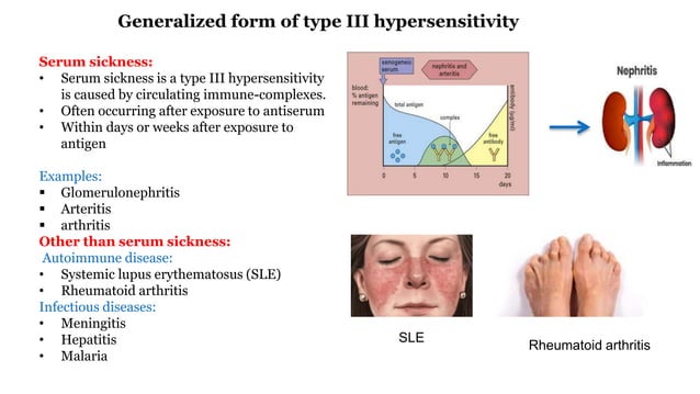 Hypersensitivity (Type 3 Hypersensitivity) | PPTX | Allergies ...