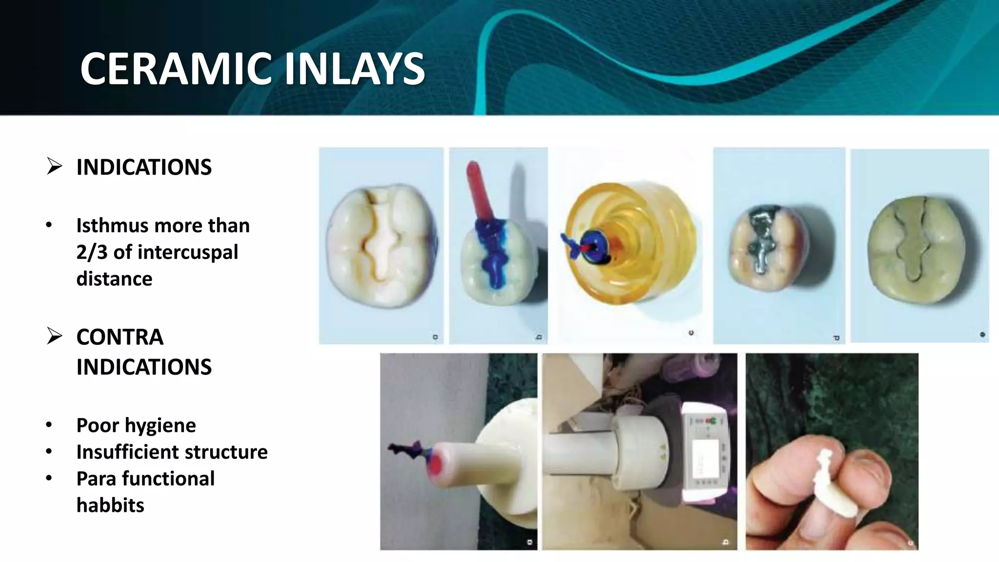 indirect restorations | PPTX