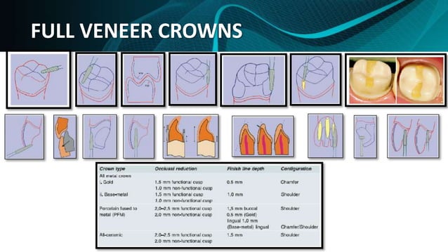 indirect restorations | PPTX | Dental Health | Diseases and Conditions