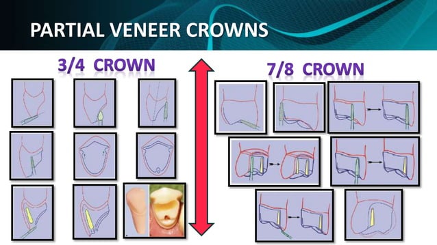 indirect restorations | PPTX | Dental Health | Diseases and Conditions