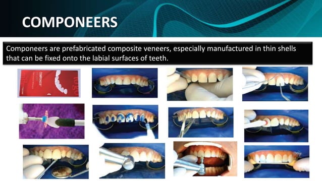 indirect restorations | PPTX | Dental Health | Diseases and Conditions