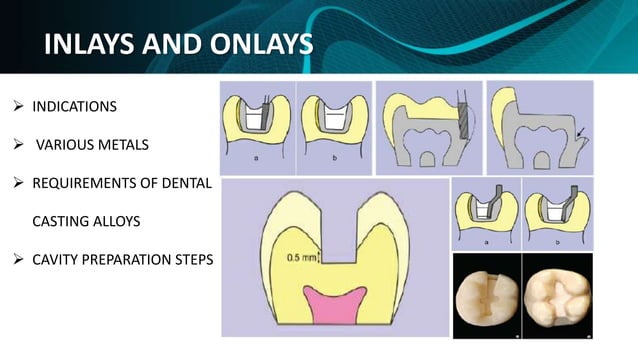 indirect restorations | PPTX | Dental Health | Diseases and Conditions
