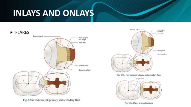 indirect restorations | PPTX | Dental Health | Diseases and Conditions
