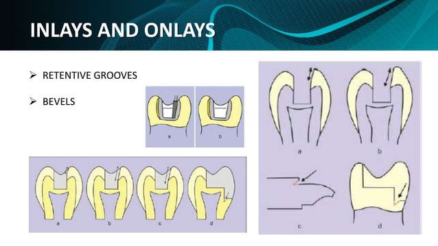 indirect restorations | PPTX | Dental Health | Diseases and Conditions