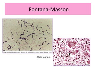 160836304 diagnostico-histologico-de-micosis-finished | PPT