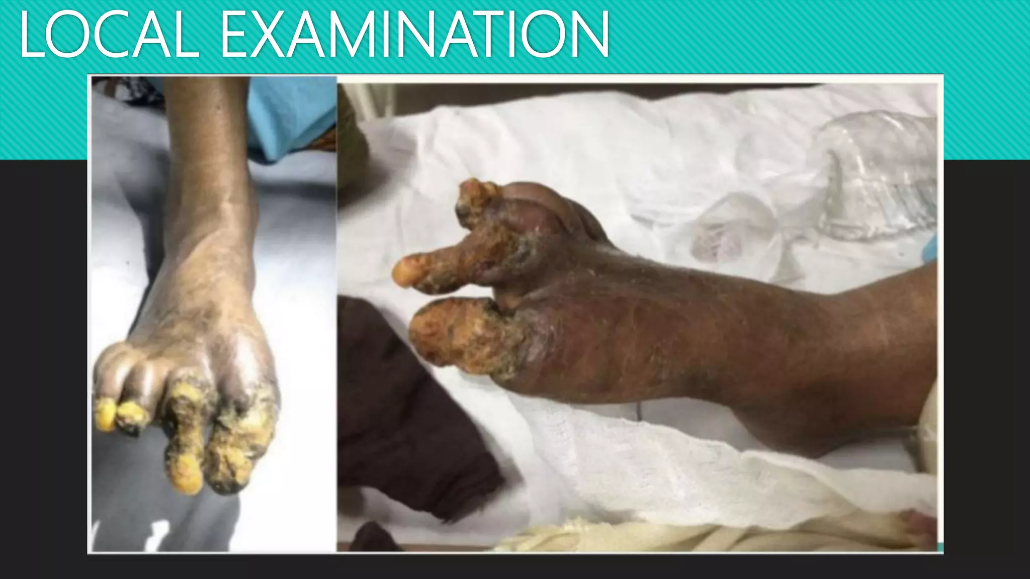 Peripheral Vascular Disease Case Presentation | PPTX