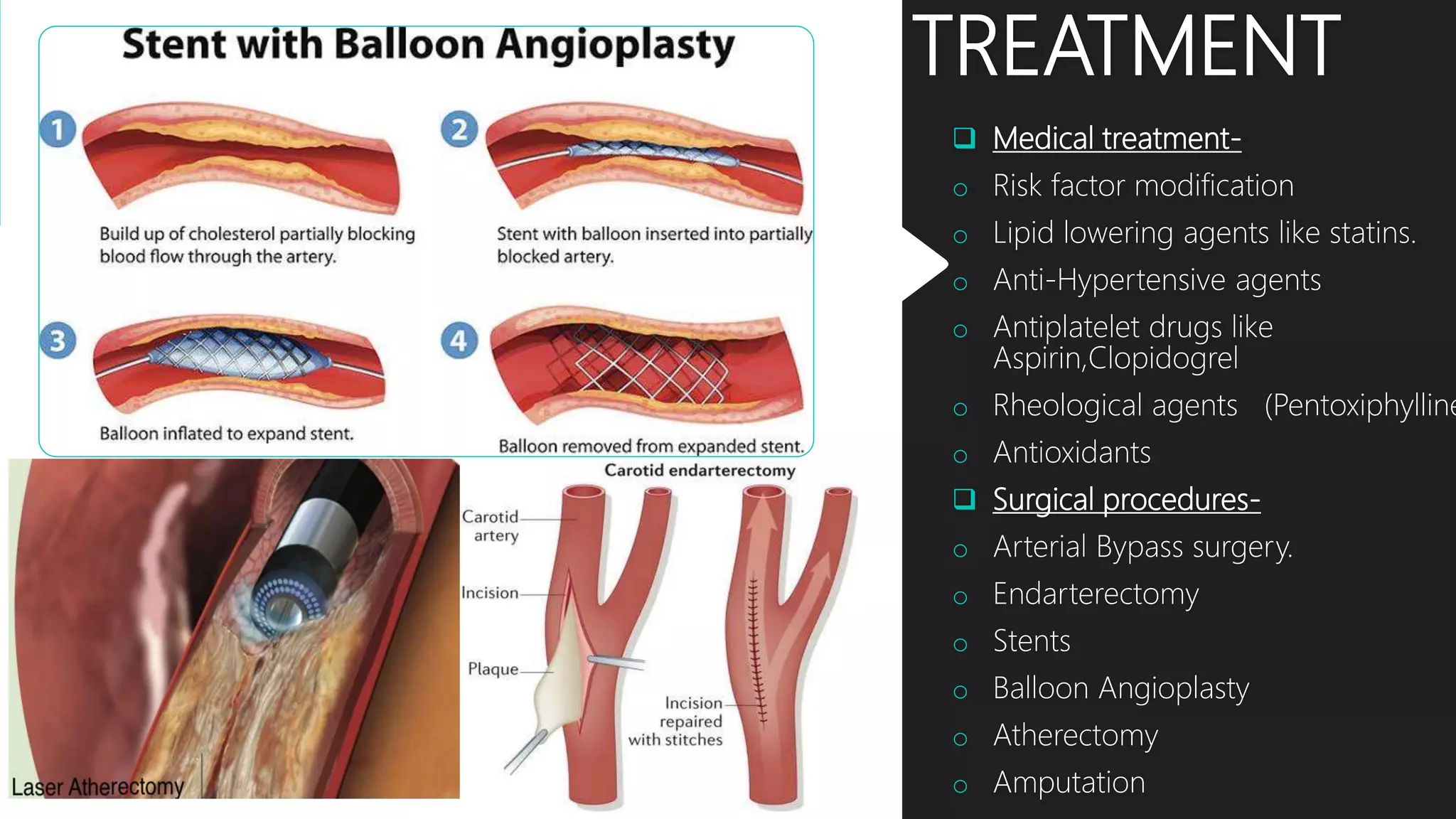 Peripheral Vascular Disease Case Presentation | PPTX