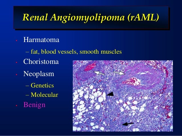 Angiomyolipoma
