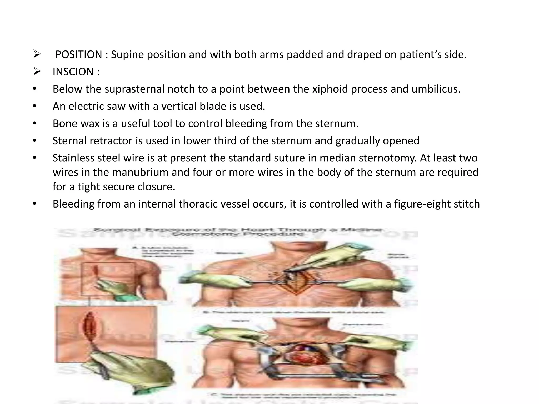 thoracic surgery | PPTX