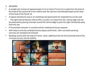 thoracic surgery | PPTX