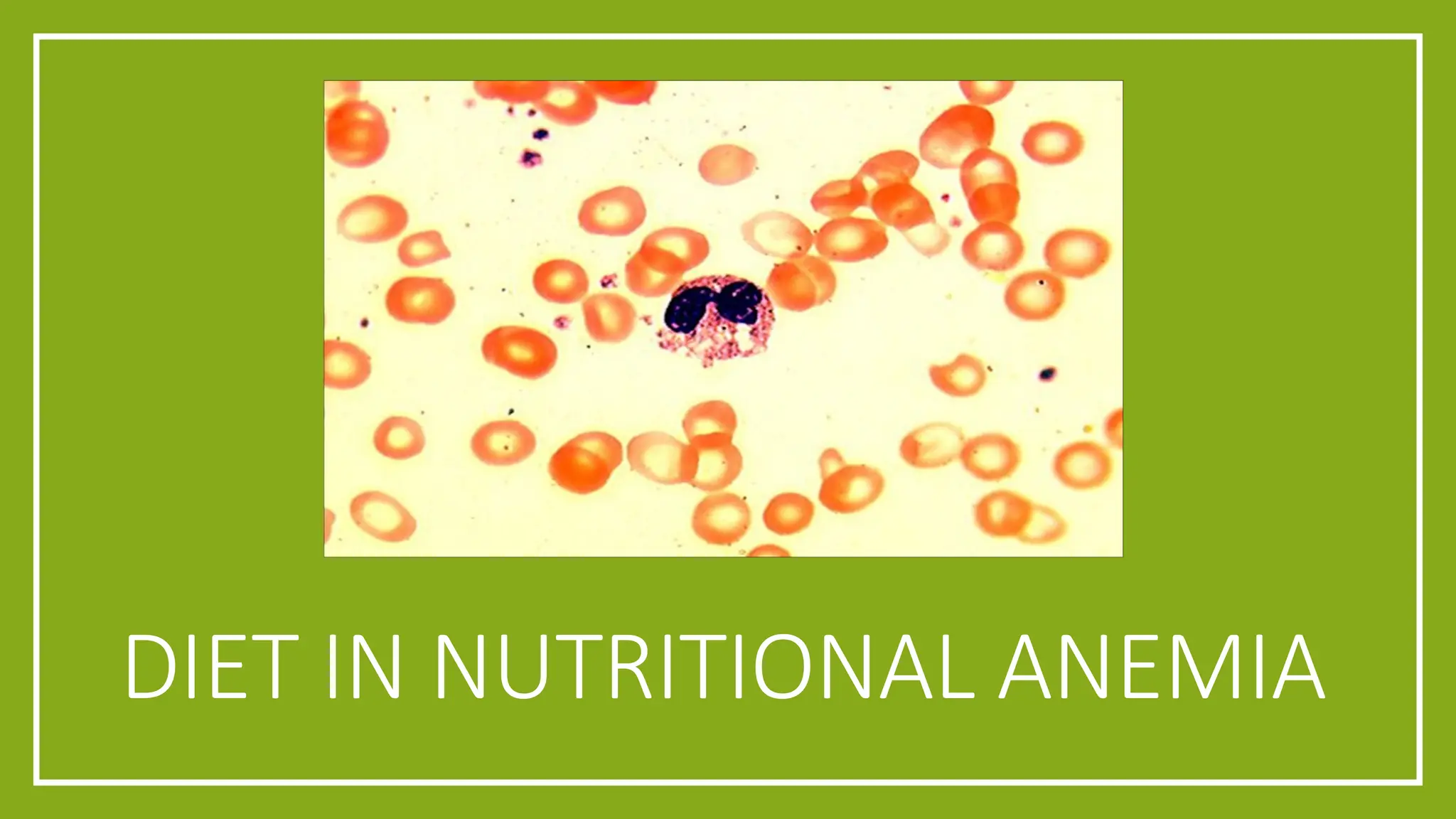 Diet in Nutritional Anemia iron deficiency | PPTX