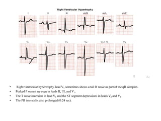 cases of ecg interpretation | PPTX
