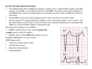 cases of ecg interpretation | PPTX