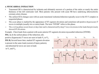 cases of ecg interpretation | PPTX