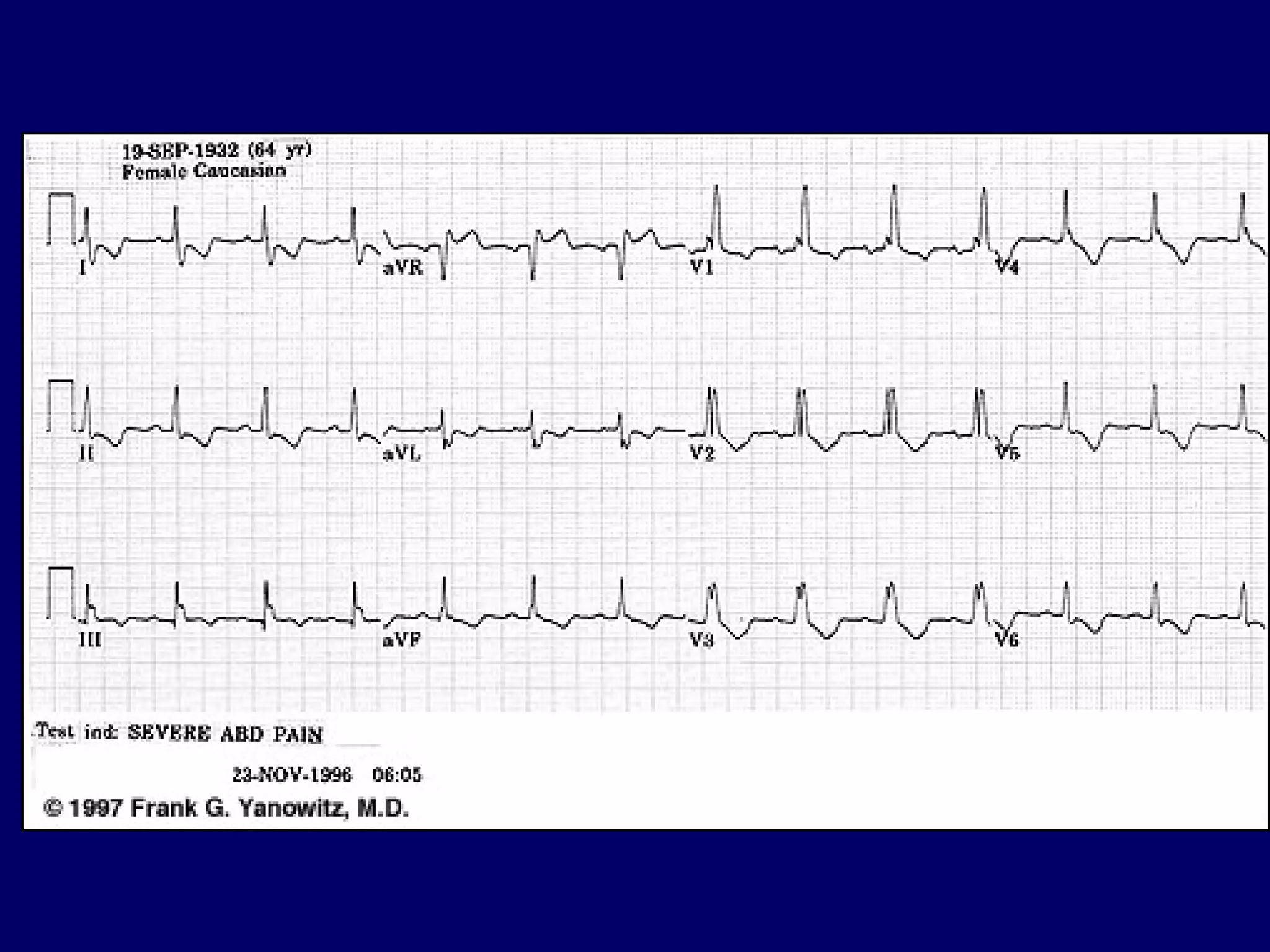 16174062-ECG-hipertrofii.pdf