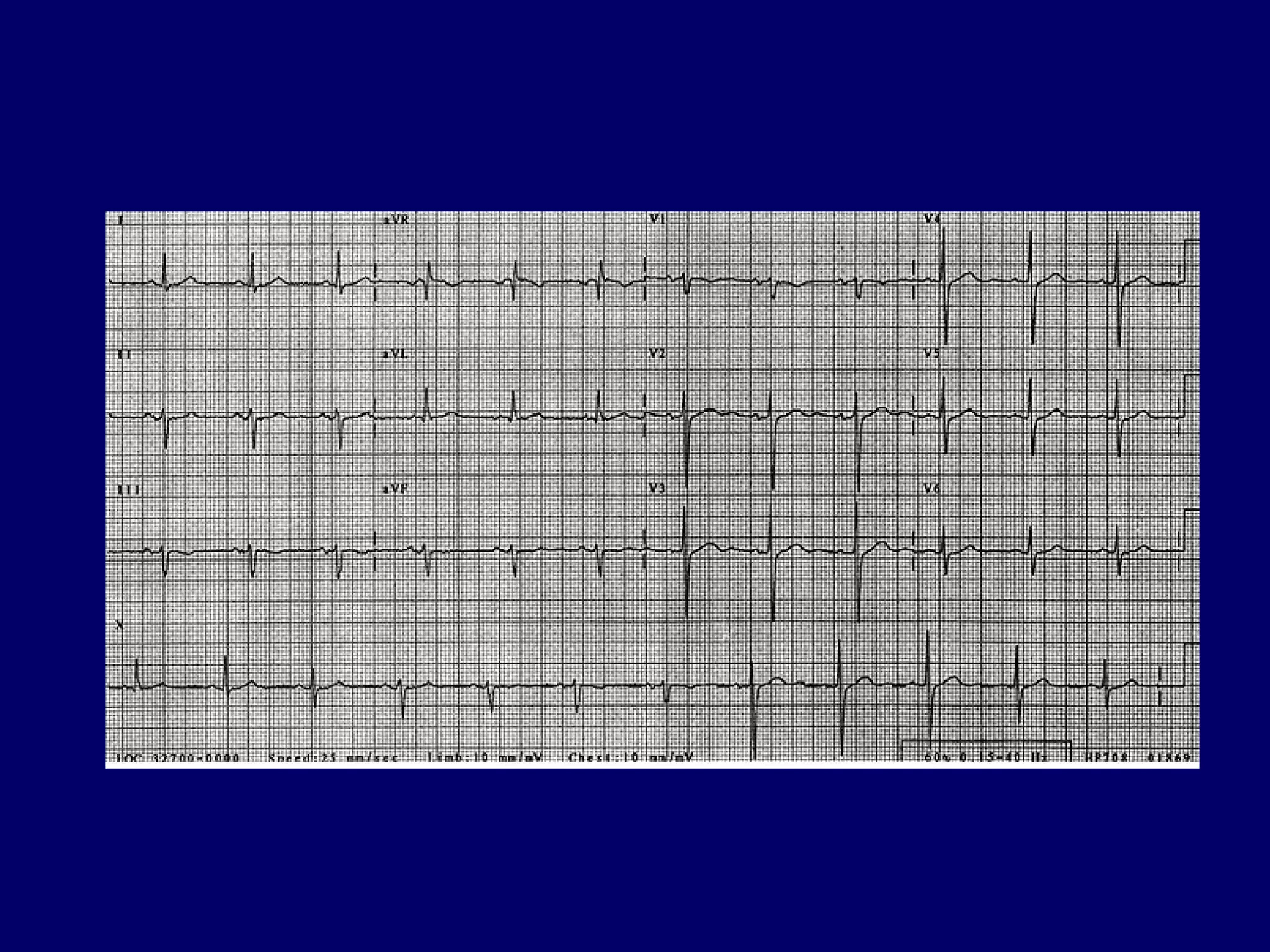 16174062-ECG-hipertrofii.pdf