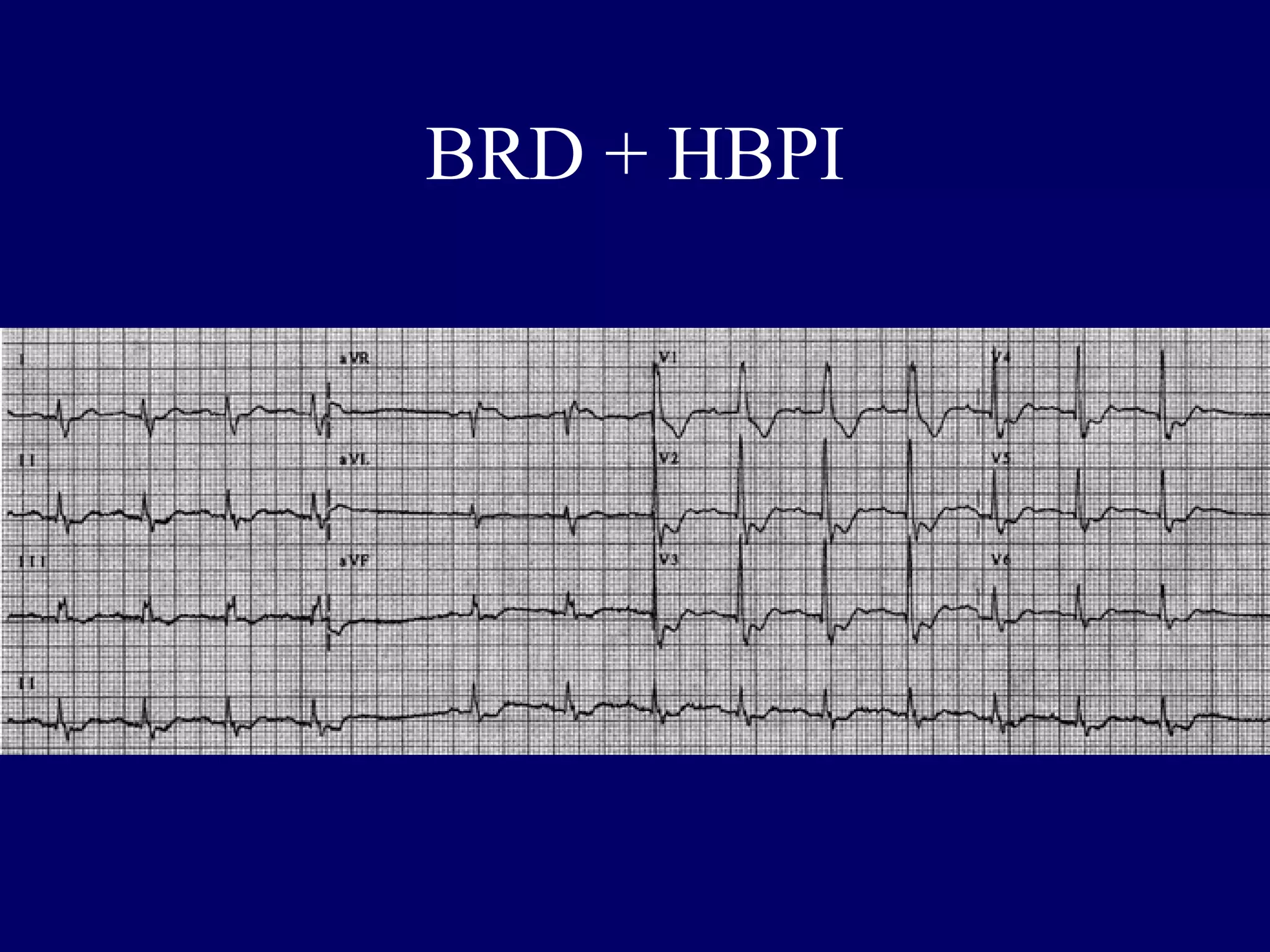 16174062-ECG-hipertrofii.pdf