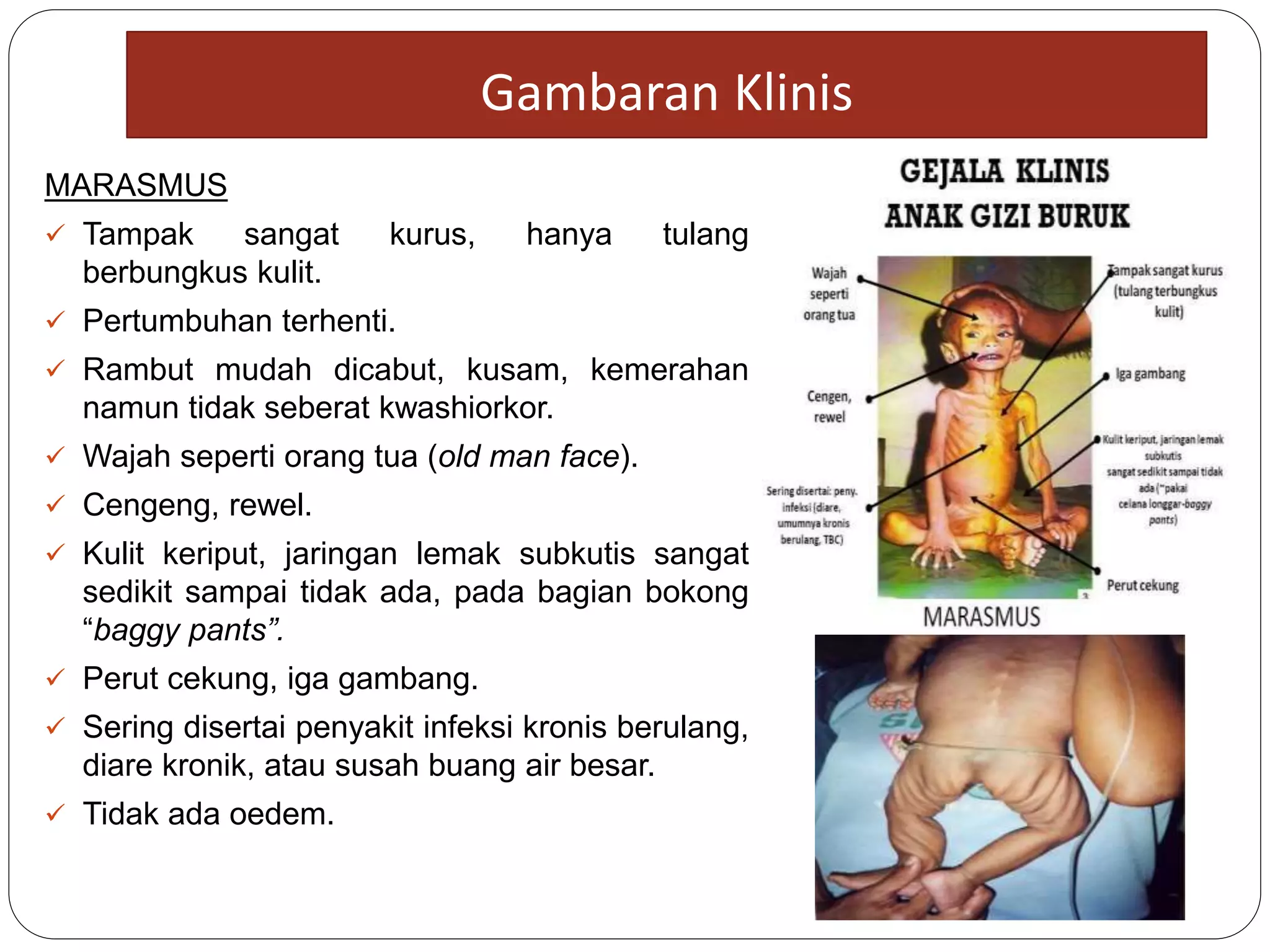 161983652-MARASMUS-PPT.pptx