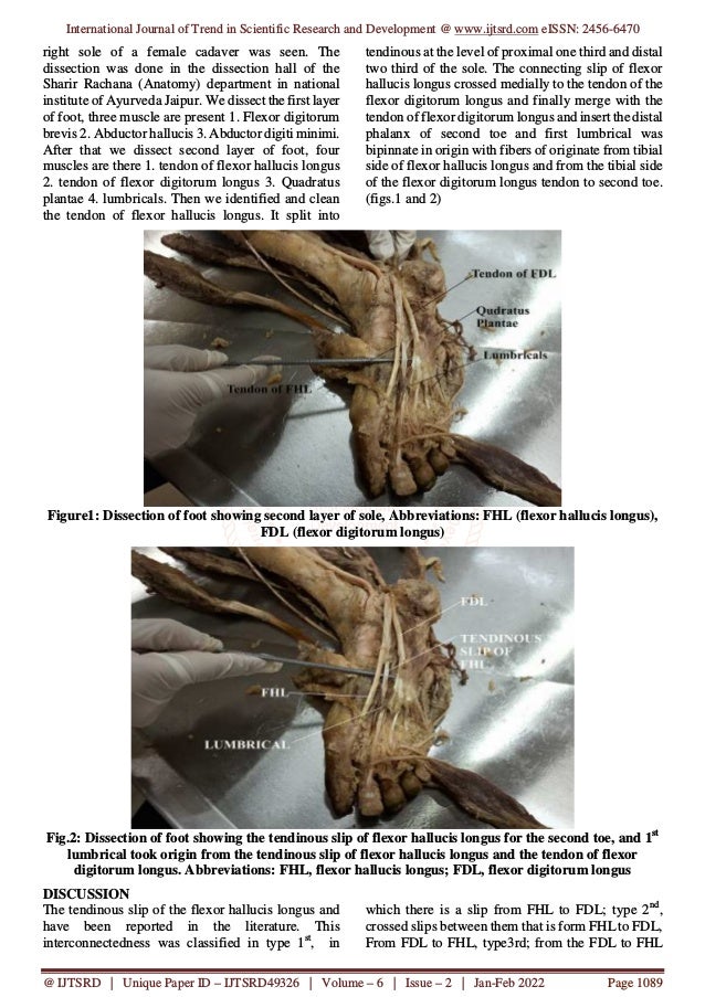 A Tendinous Slip of the Flexor Hallucis Longus for the Second Toe An ...