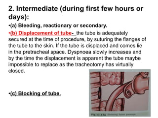 Tracheostomy complications pediatric by Aditya Rana mbbs | PPT