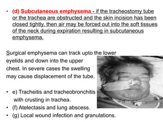 Tracheostomy complications pediatric by Aditya Rana mbbs | PPT