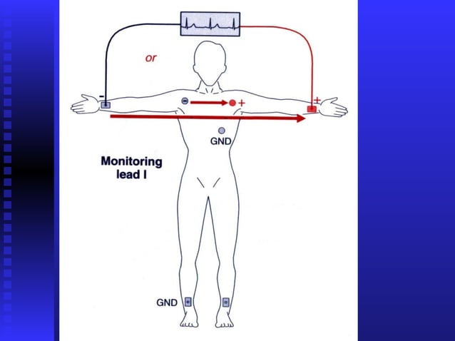 ekg-lengkap-ppt | PPT