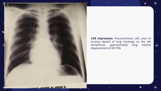 Pneumothorax | PPT