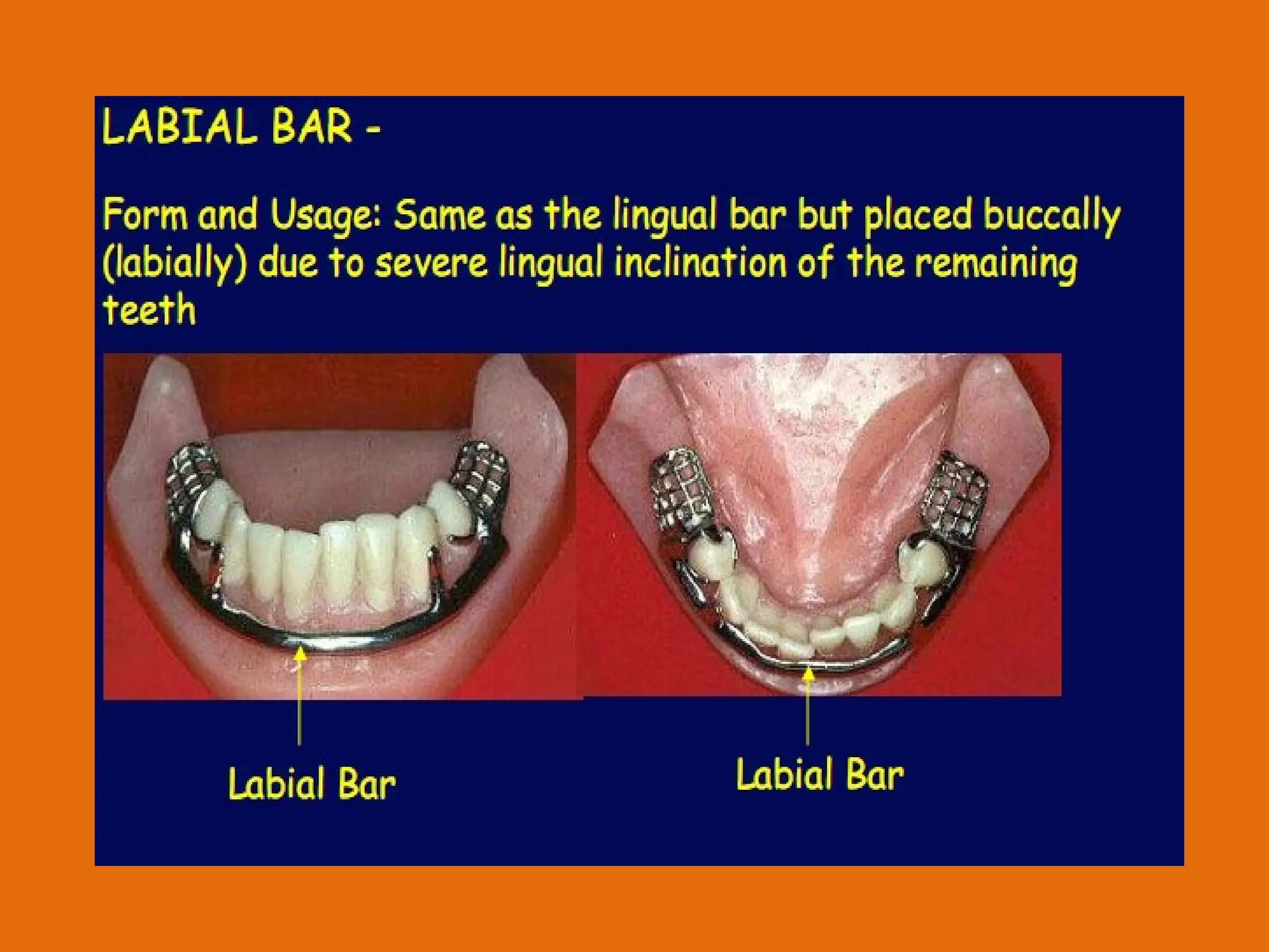 1659908partial denture classification .ppt