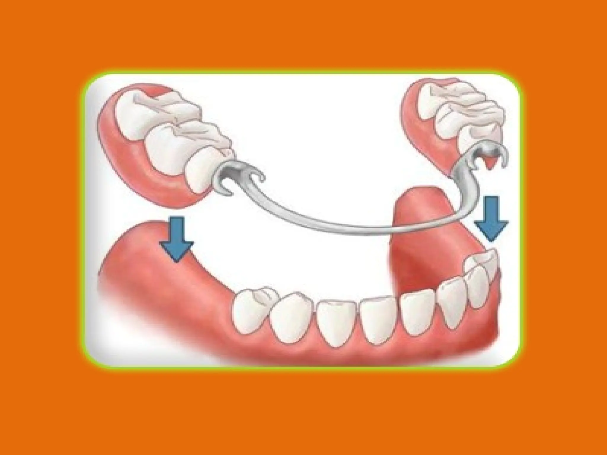 1659908partial denture classification .ppt