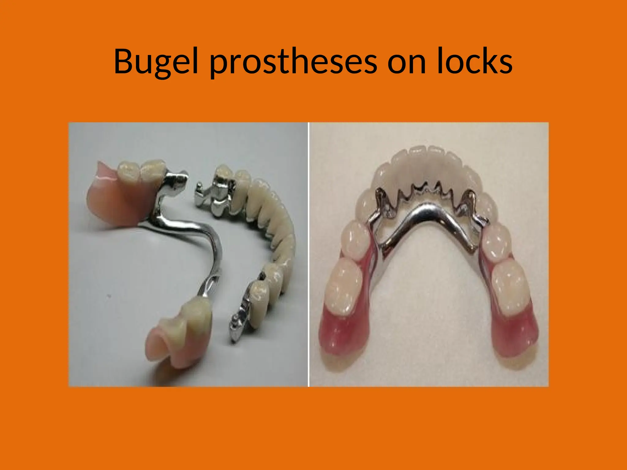 1659908partial denture classification .ppt