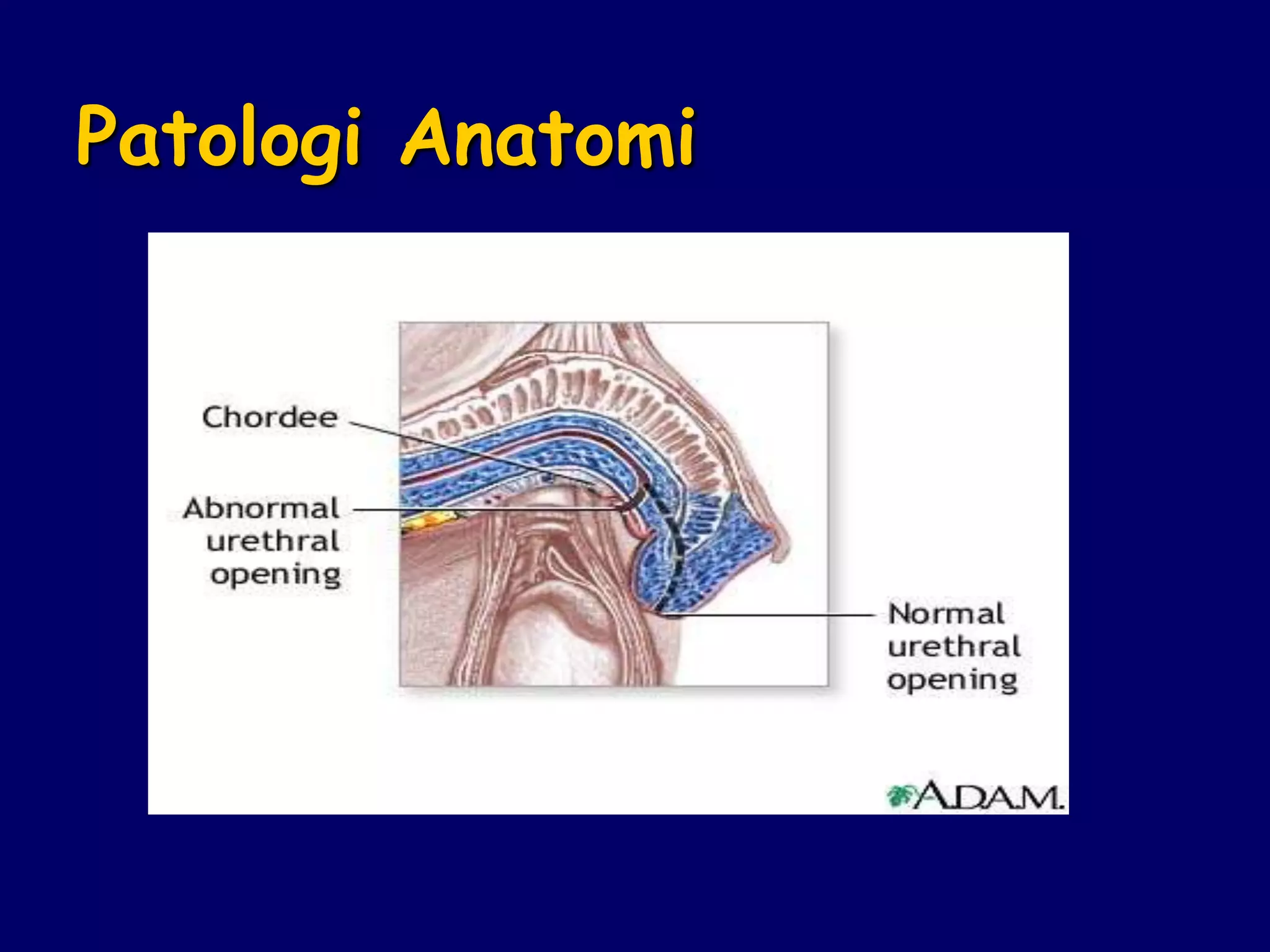 16606301 hipospadia | PPT
