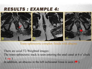 Mri imaging of fistula : its inputs implications for surgical ...