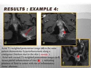 Mri imaging of fistula : its inputs implications for surgical ...