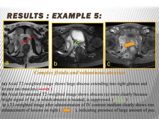 Mri imaging of fistula : its inputs implications for surgical ...