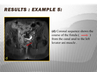Mri imaging of fistula : its inputs implications for surgical ...