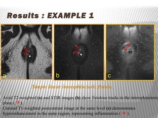 Mri imaging of fistula : its inputs implications for surgical ...