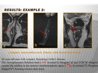 Mri imaging of fistula : its inputs implications for surgical ...