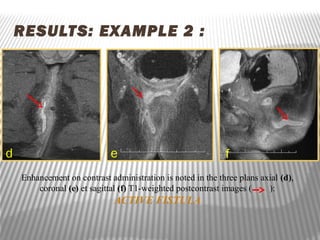 Mri imaging of fistula : its inputs implications for surgical ...
