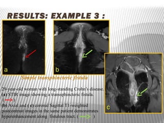 Mri imaging of fistula : its inputs implications for surgical ...