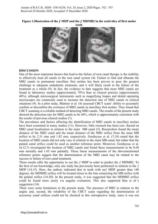 Radiographic Evaluation of the MB2 Canal in Permanent Maxillary Molars ...