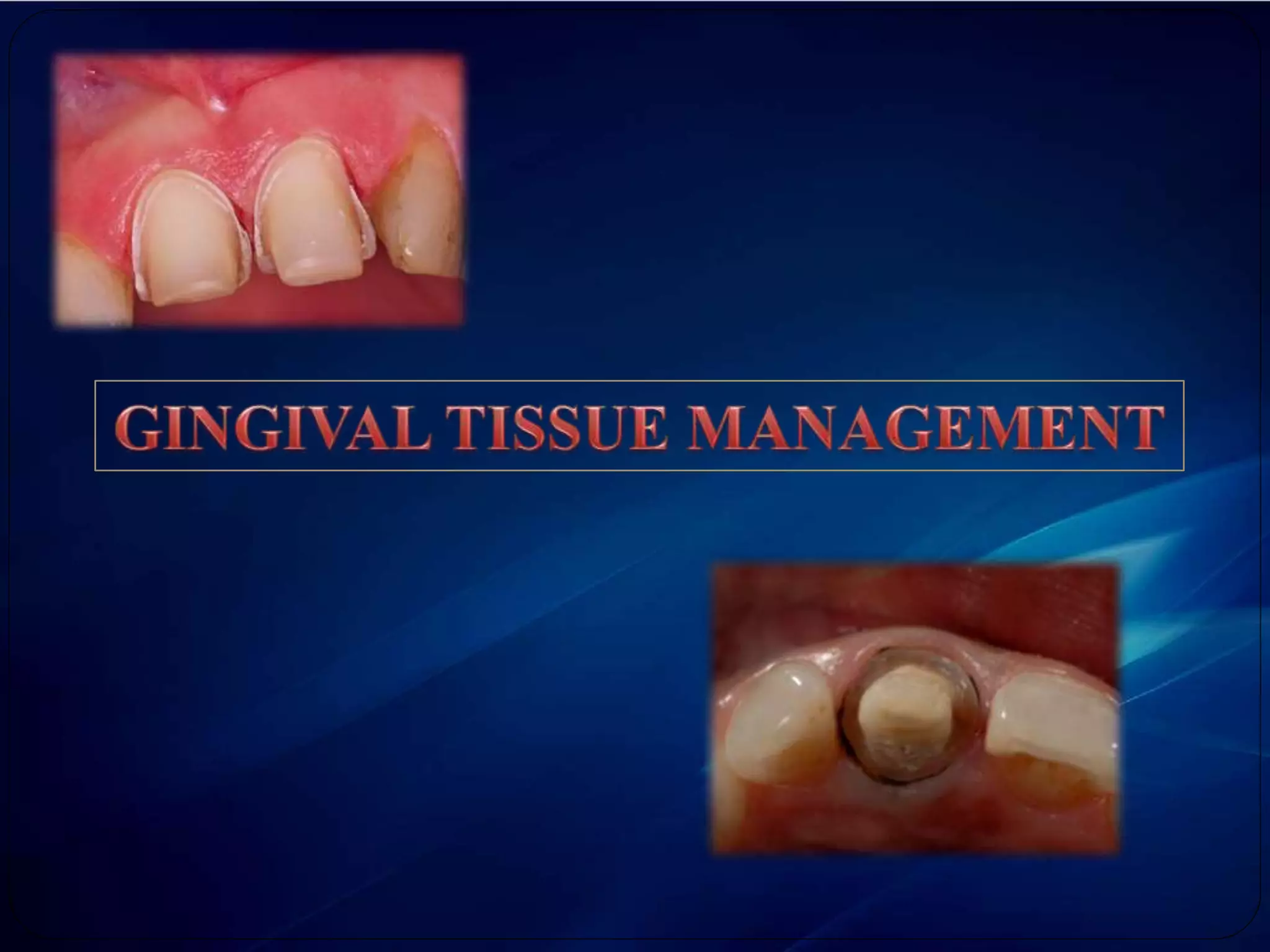 gingival tissue management | PPTX