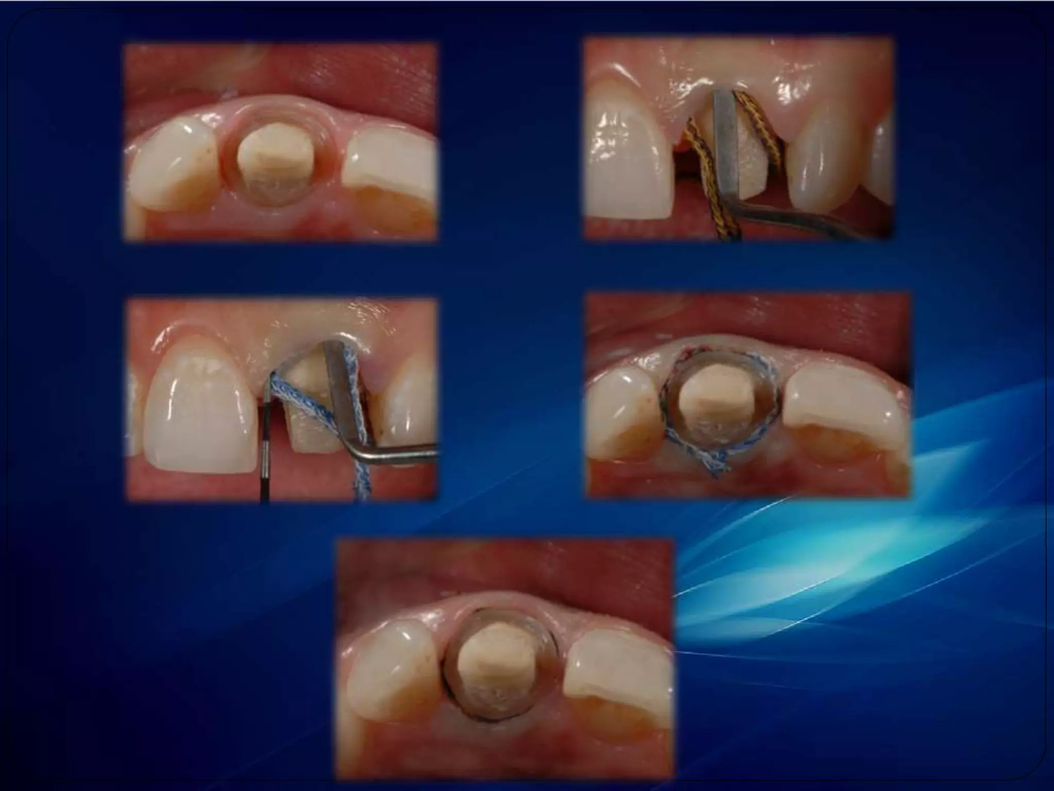 gingival tissue management | PPTX
