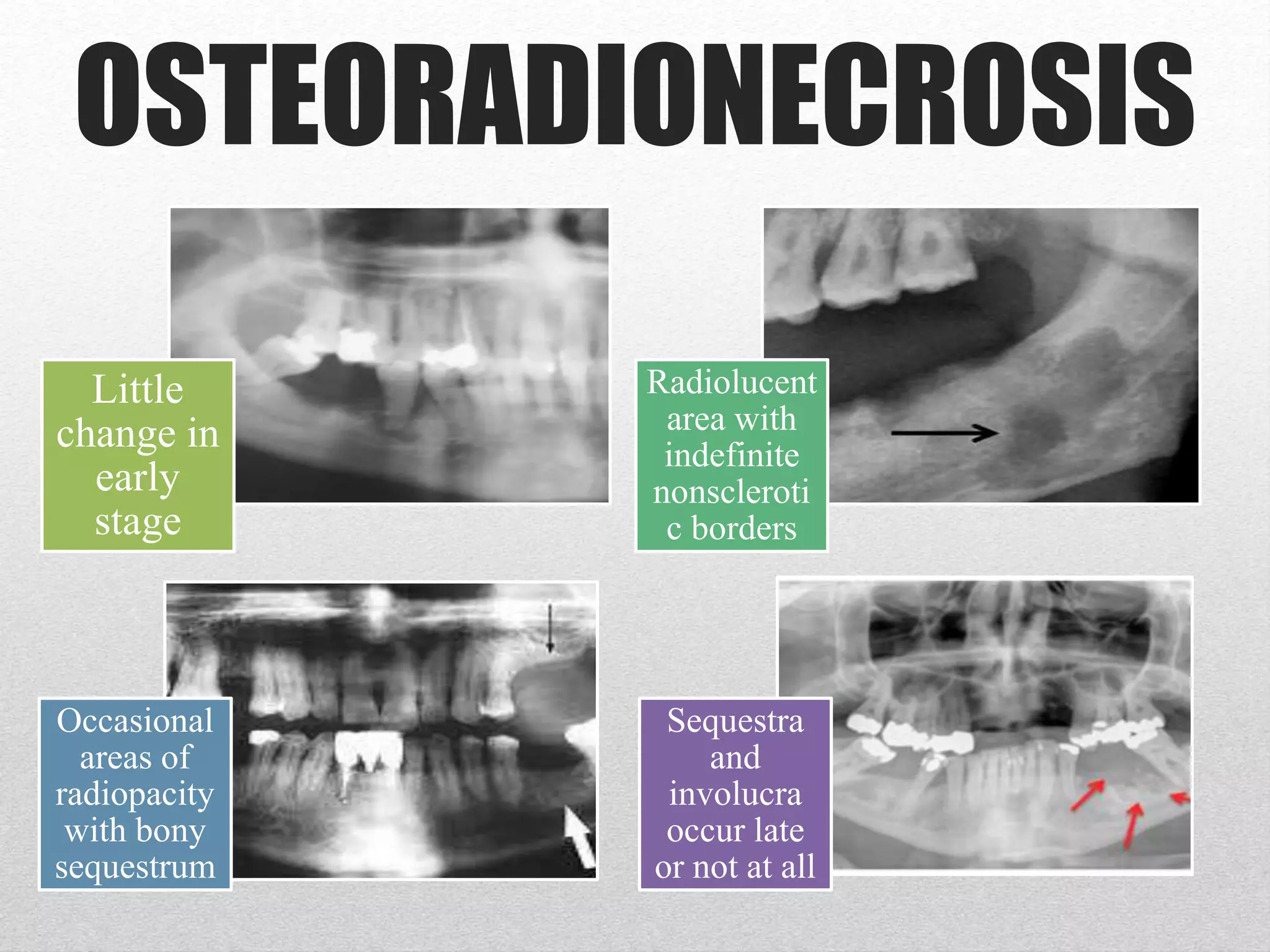Protocol of Dental Treatment in Radiotherapy Indicated Patients.pptx