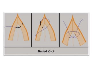 suturing and wound closure made easy in this | PPTX