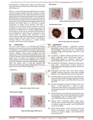 Melanoma Skin Cancer Detection using Image Processing and Machine ...