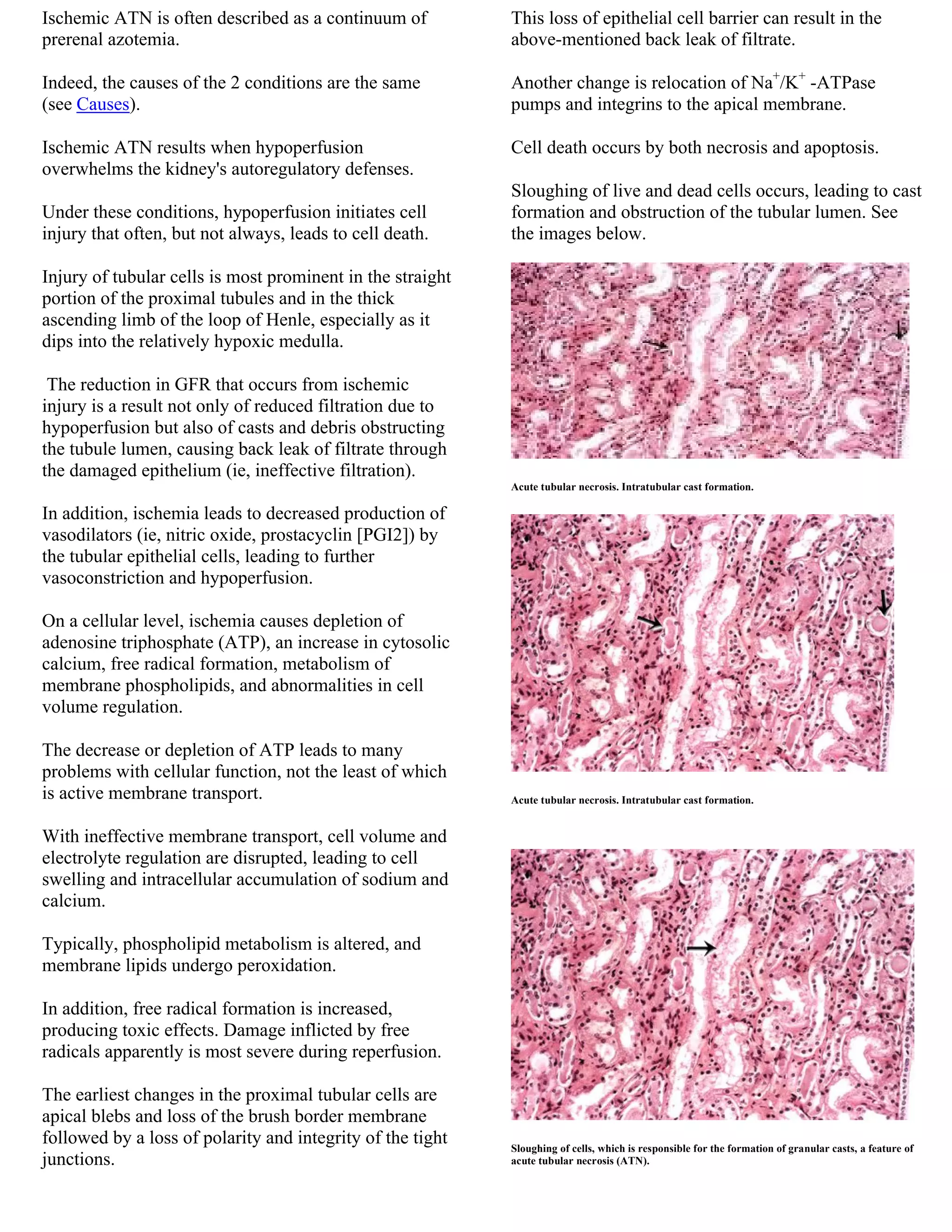 Acute Tubular Necrosis | PDF