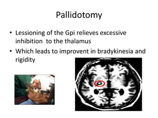 Frameless DBS For Movements Disorders | PPTX